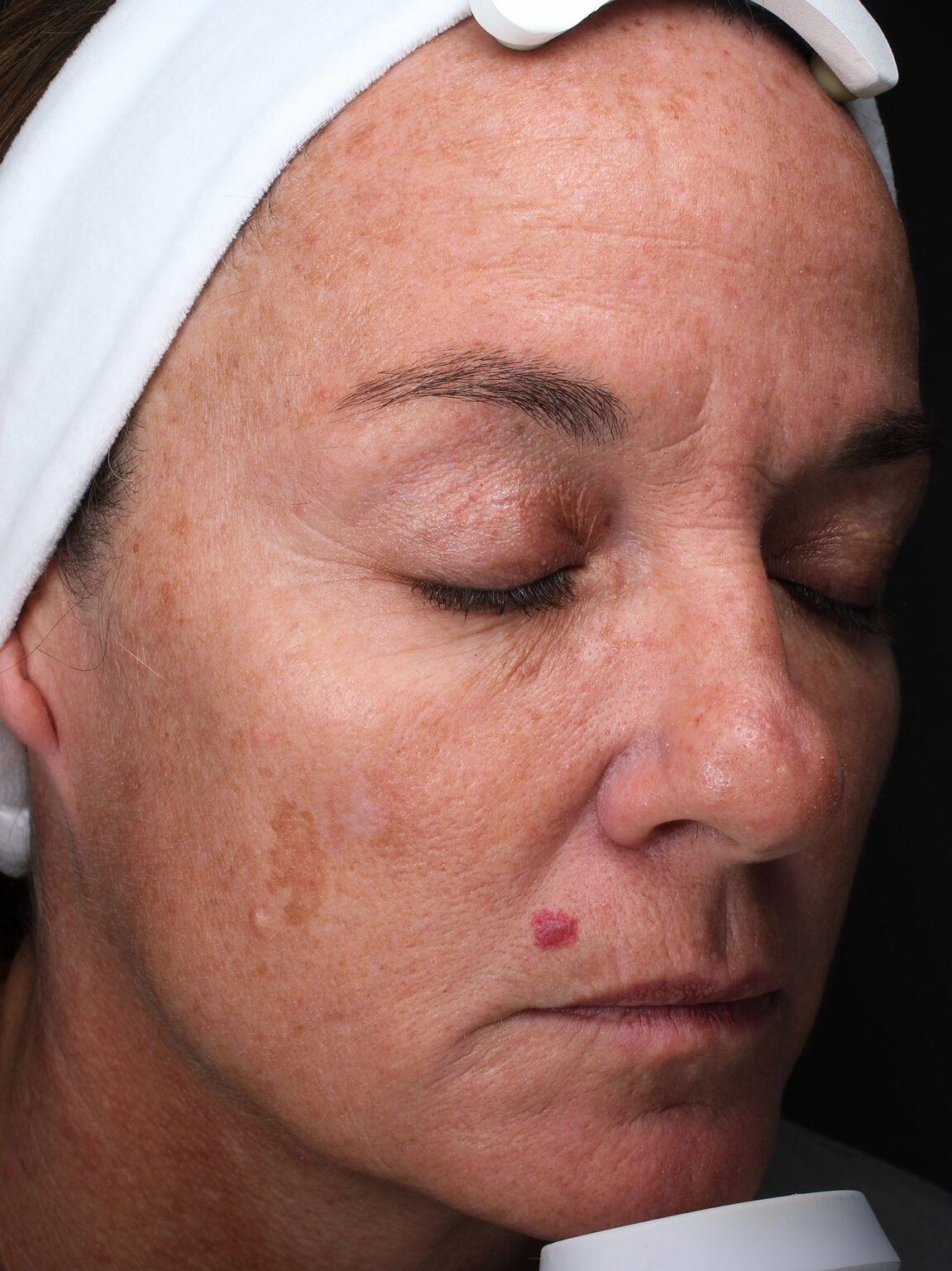 HALO Laser BBL Combo Patient 2 - Blush Aesthetics